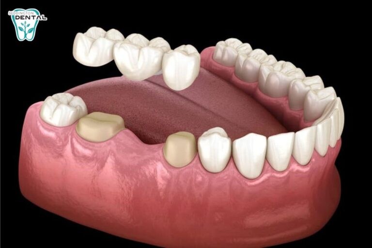 What Are Dental Bridges and How Do They Work? - Beddington Dental Clinic